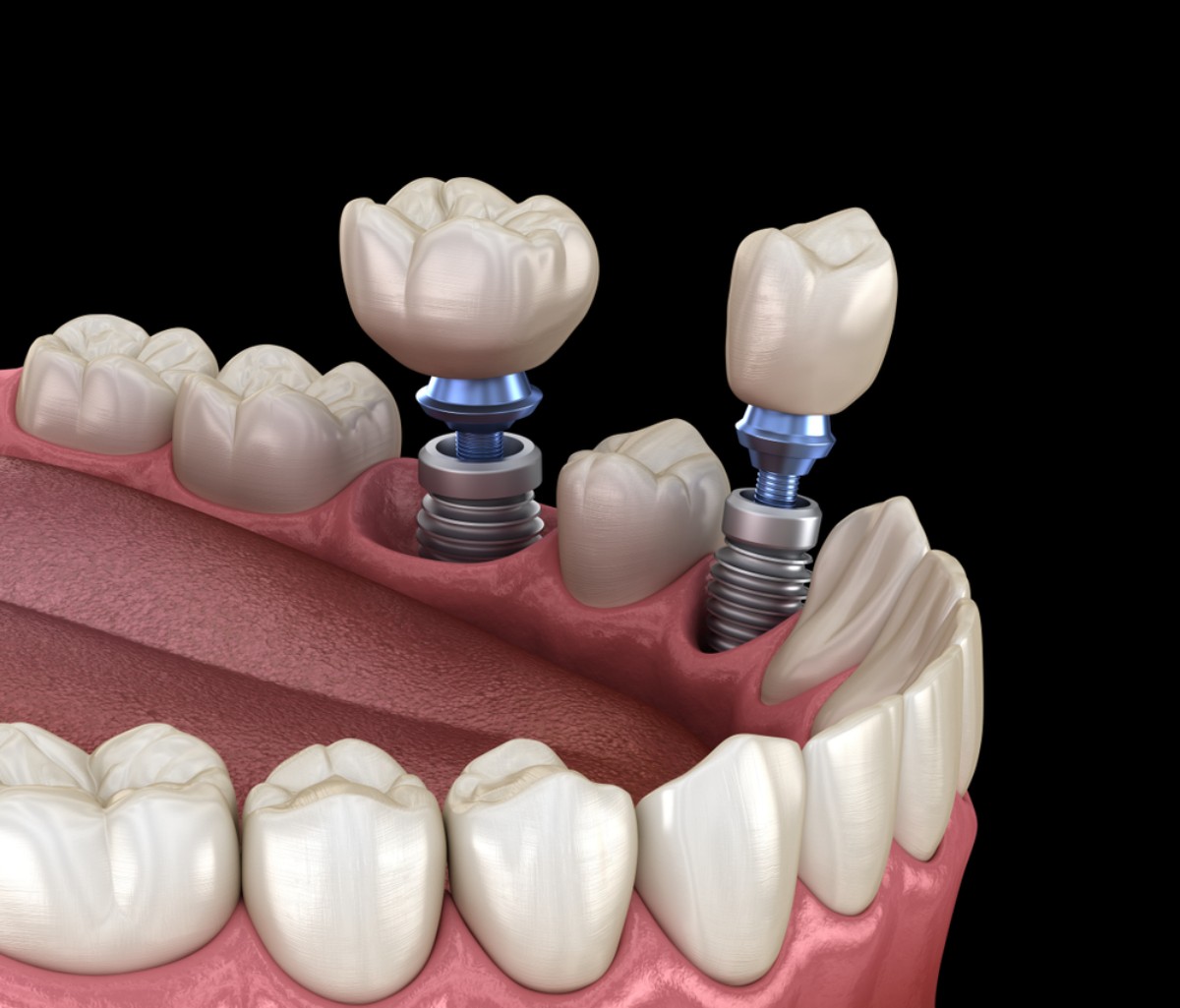 Dental Implants in Dayton, OH | Gamber Family Dental