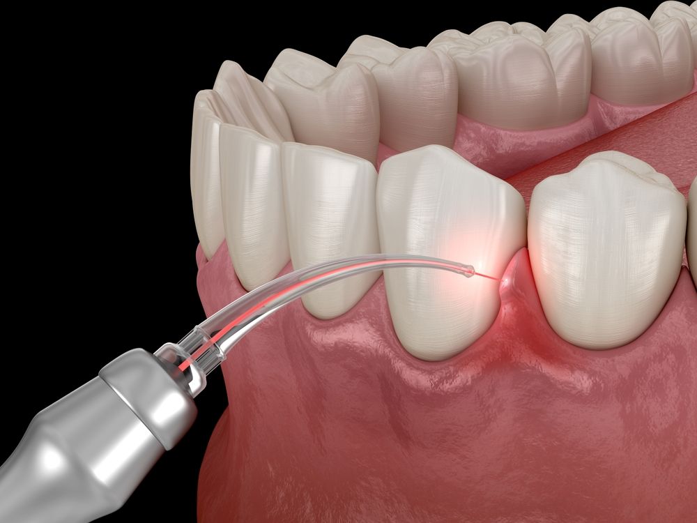 Dental Laser Surgery in Dayton, OH | Gamber Family Dental